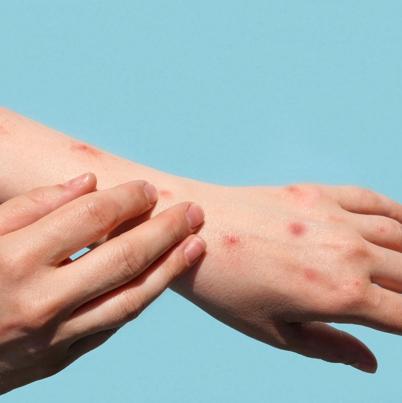 Varíola dos macacos: entenda a transmissão, os sintomas e a vacina – O ...